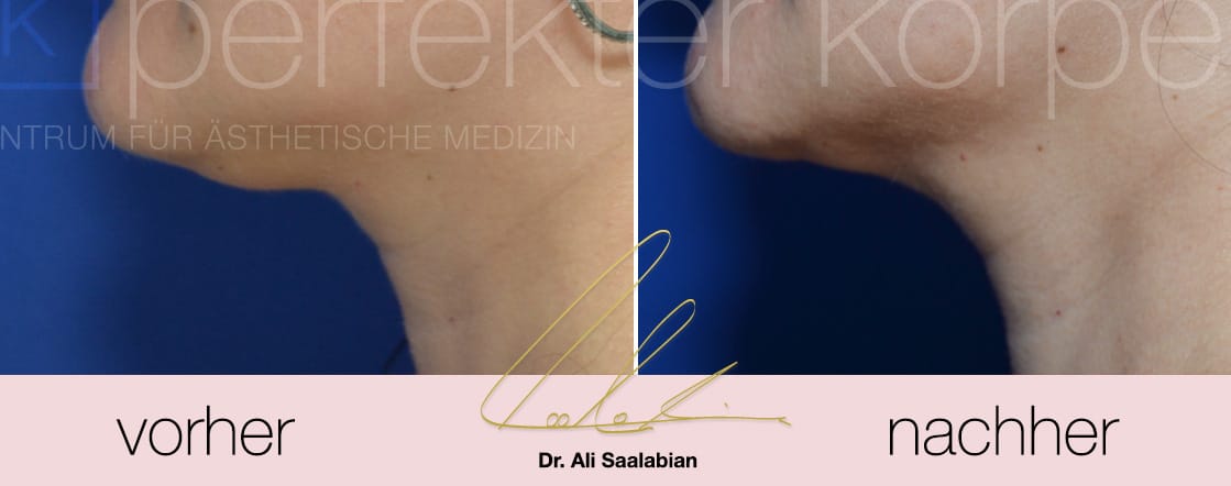 Fettabsaugung Hals/Doppelkinn - Perfekter Körper, 1010 Wien