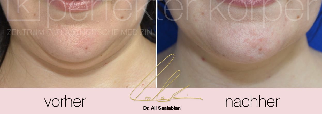 Fettabsaugung Hals/Doppelkinn - Perfekter Körper, 1010 Wien